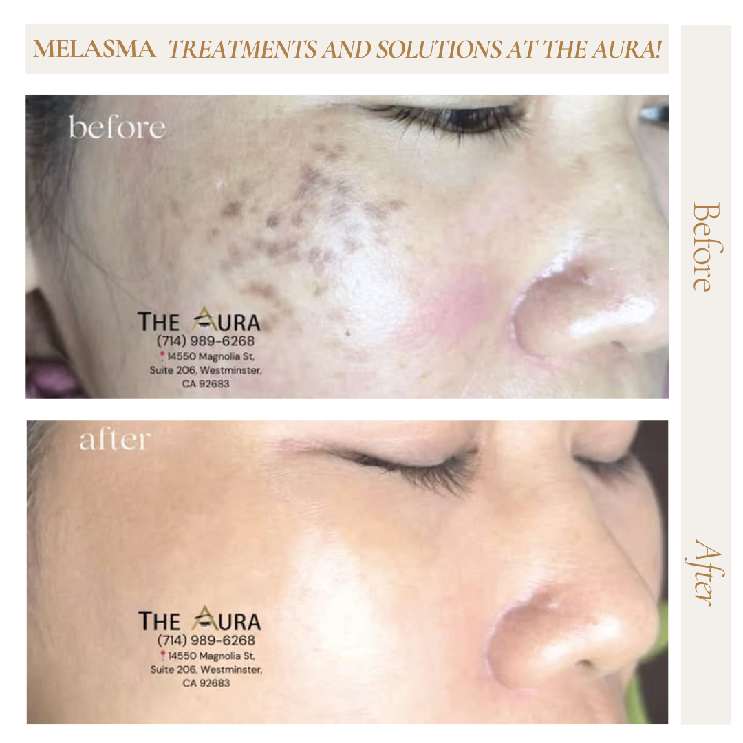 MELASMA - CAUSES, TREATMENTS AND SOLUTIONS